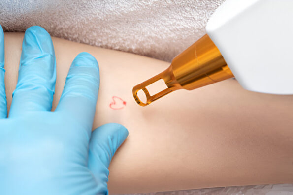 Tattoo Laser (Color Ink) - Imma Serilaris SPA & Aesthetic